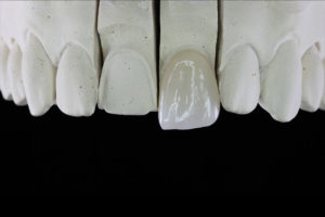 Cadmus Dental Lab | Crown and Bridge